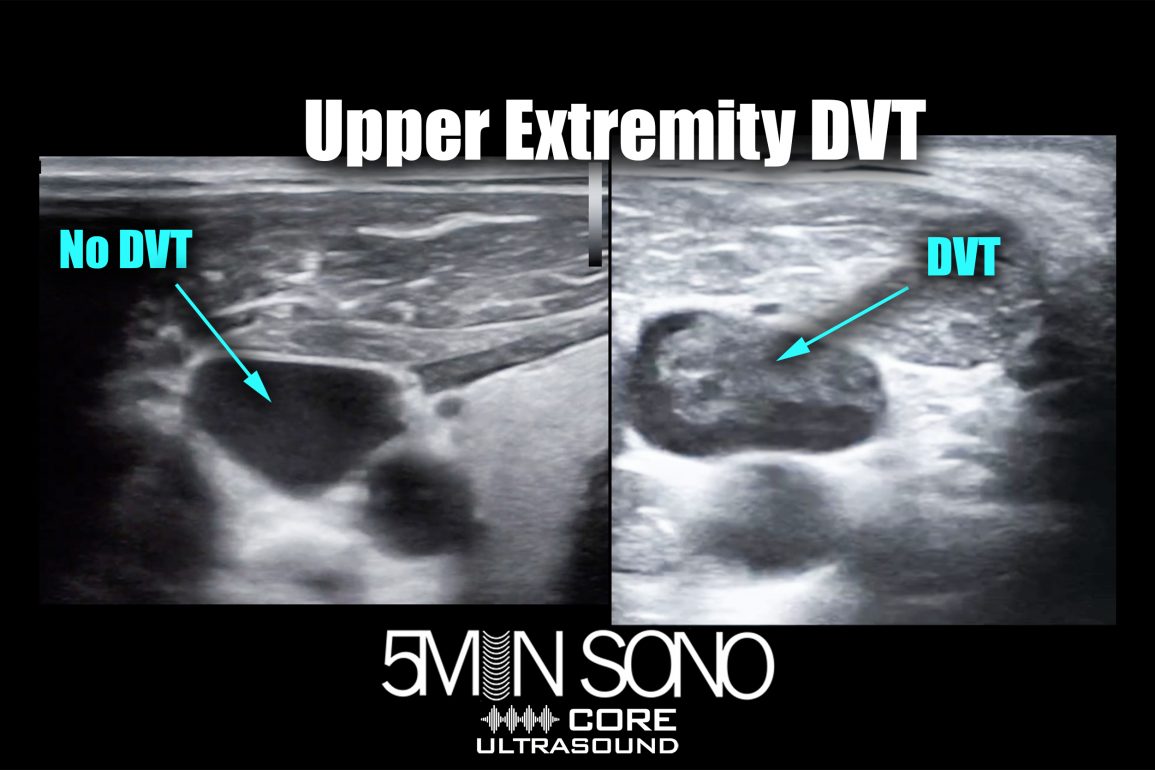 DVT Core Ultrasound