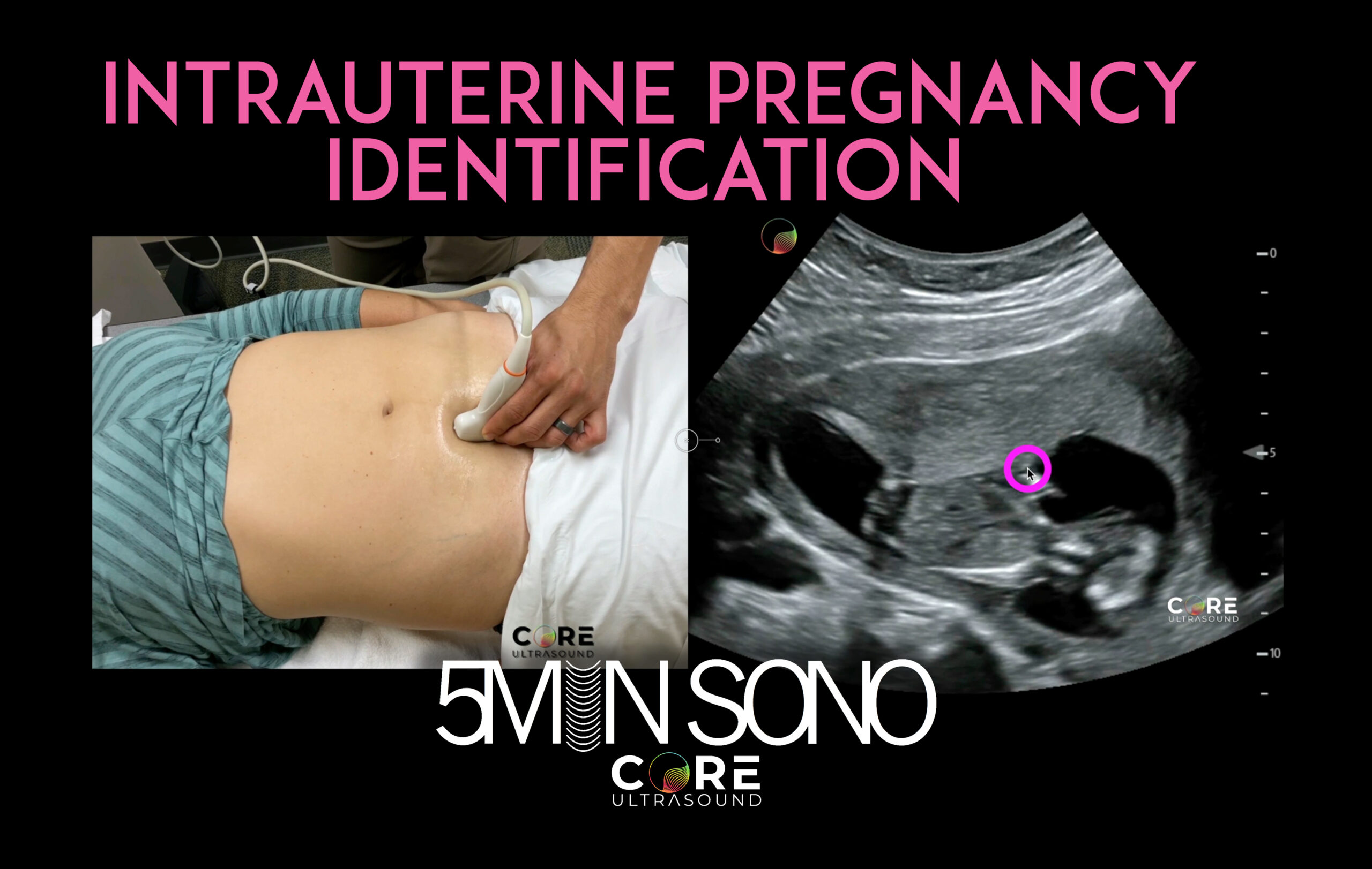 Intrauterine Pregnancy Intrauterine Pregnancy OB/GYN Case Studies